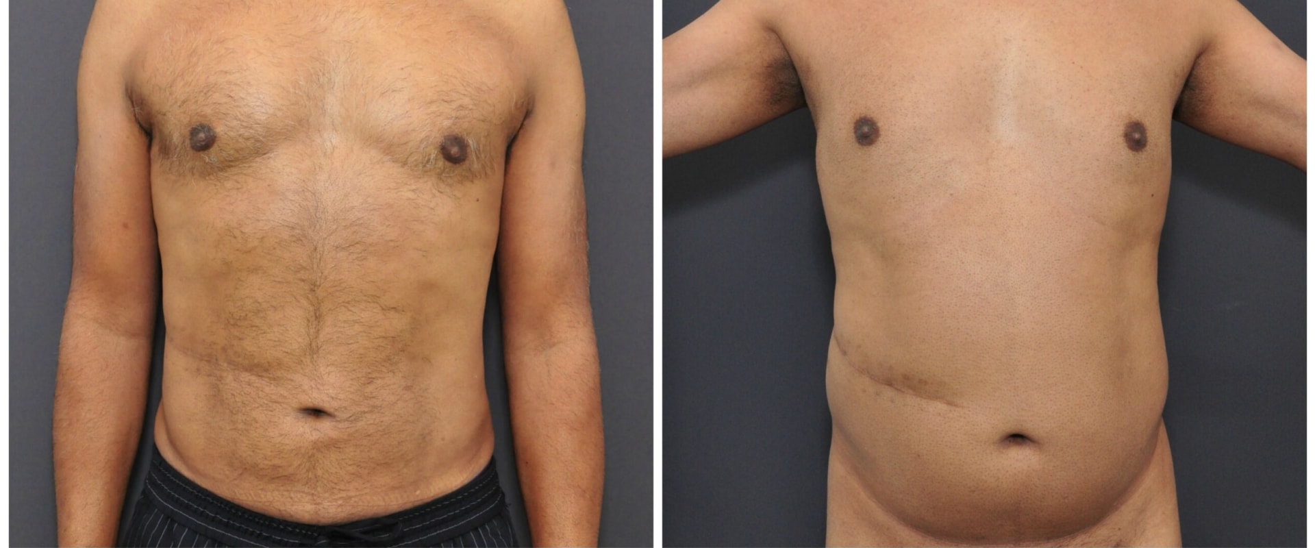 What to Expect After Liposuction: A Surgeon's Perspective